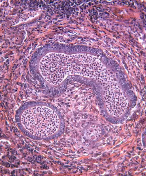 Abscess - Atlas Infectious Disease Practice